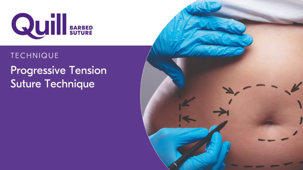 Progressive Tension Suture Technique - Corza Medical Global