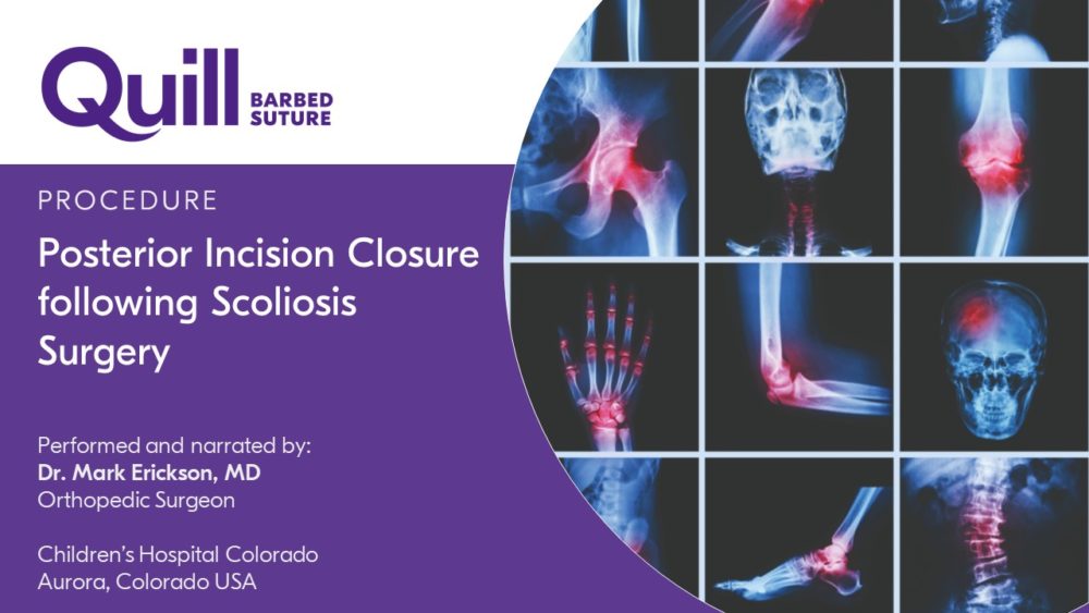 Posterior Incision Closure following a Scoliosis Surgery - Corza ...