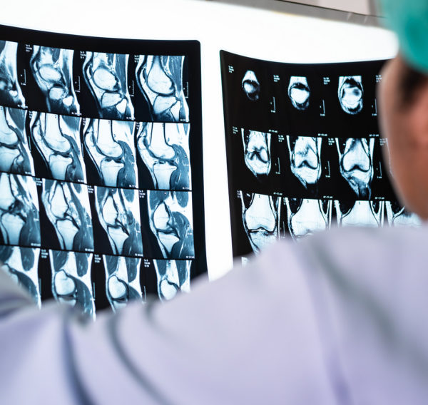 Three Layer Closure using Quill Barbed Suture in a THA Procedure ...