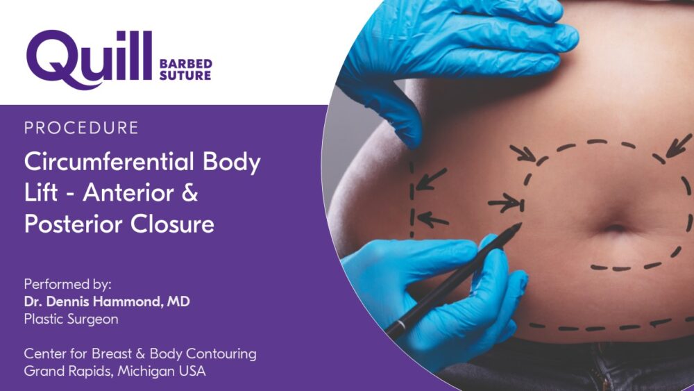 Circumferential Body Lift - Anterior and Posterior Closure by Dr ...