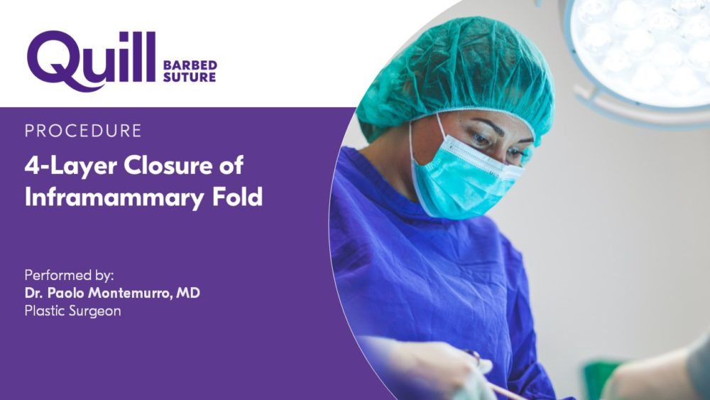Four-Layer Wound Closure of Inframammary Fold with Quill Barbed Suture ...