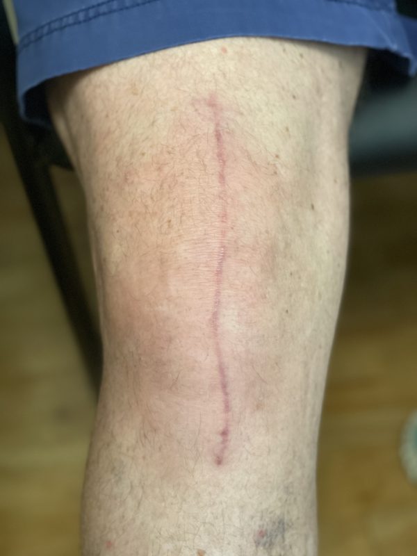 Three-Layer Closure with Quill Barbed Suture in a TKA Procedure - Corza ...