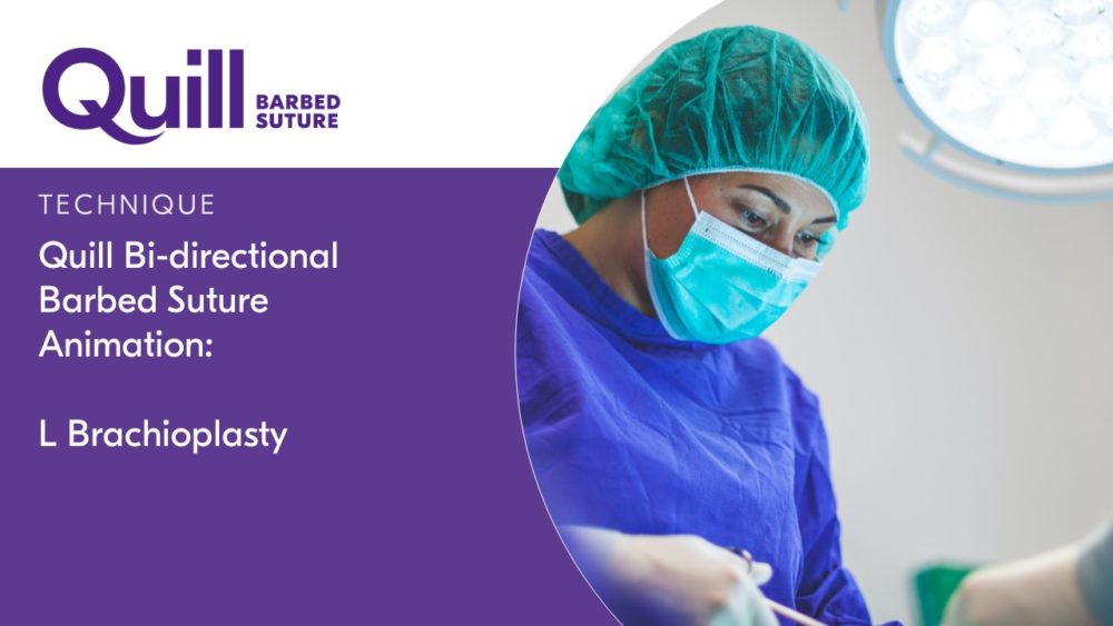 Quill Bi-Directional Barbed Suture Animation: L Brachioplasty Procedure ...