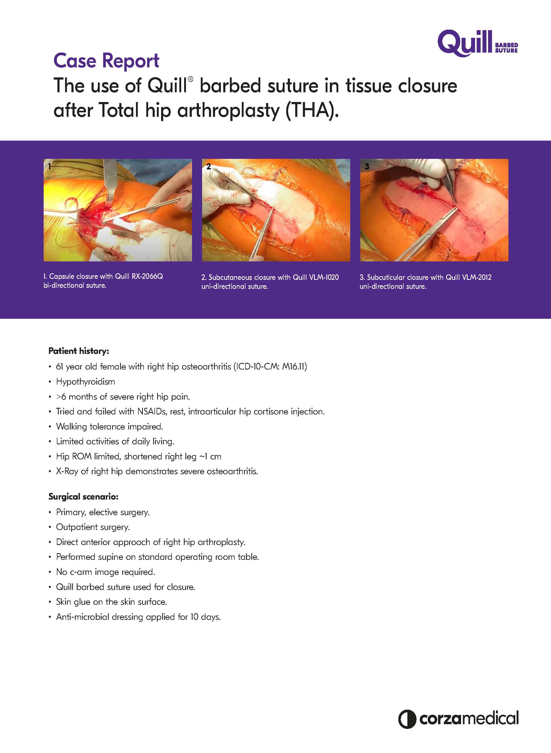Case report: The use of Quill barbed suture in tissue closure after ...