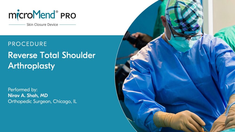 Reverse Total Shoulder Arthroplasty with MicroMend PRO - Corza Medical